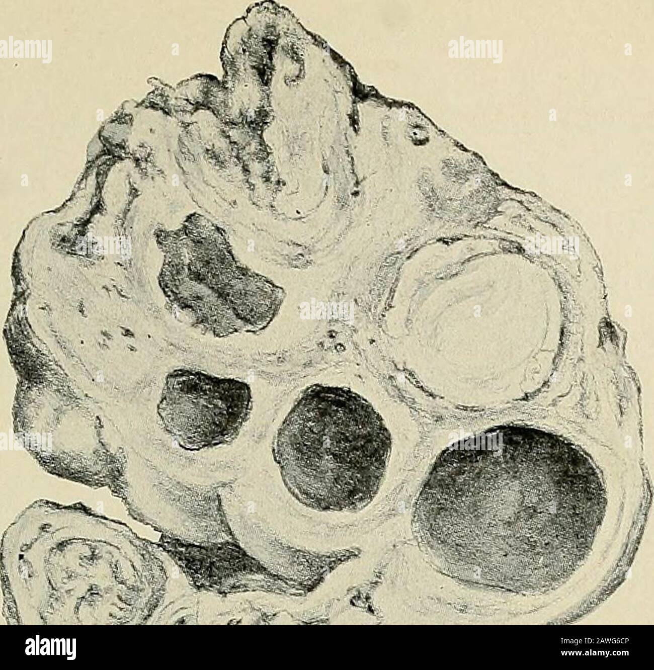 Gynecology . Fig. 147.—Colloid Carcinoma of the Ovary. (Metastatic ...
