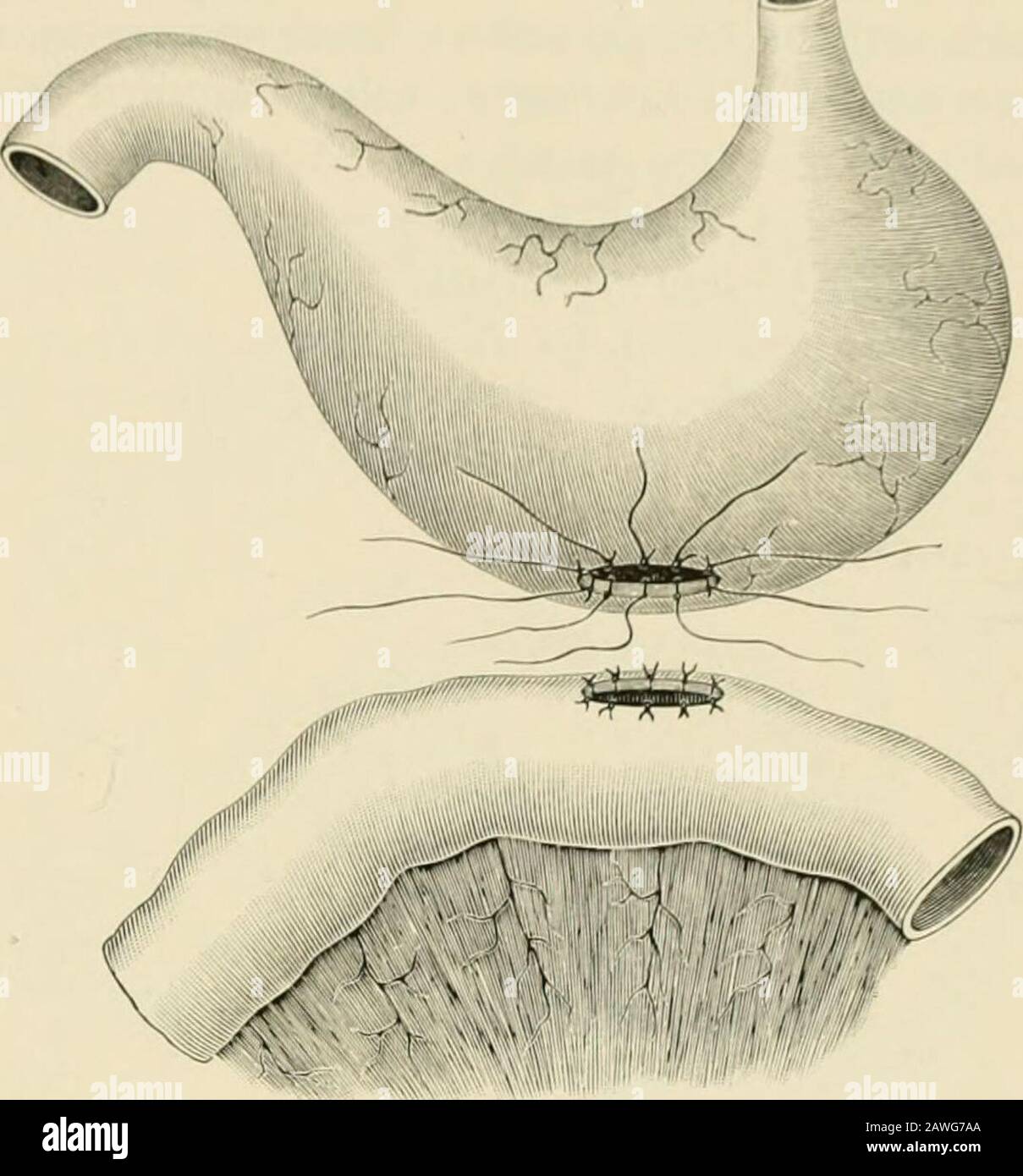 Operative surgery . Fig. 976.—The operation of gastro-enterostomy ...