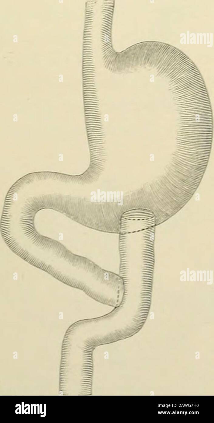 Operative surgery . Fig. 970.—The operation of anterior gastro-enteros ...