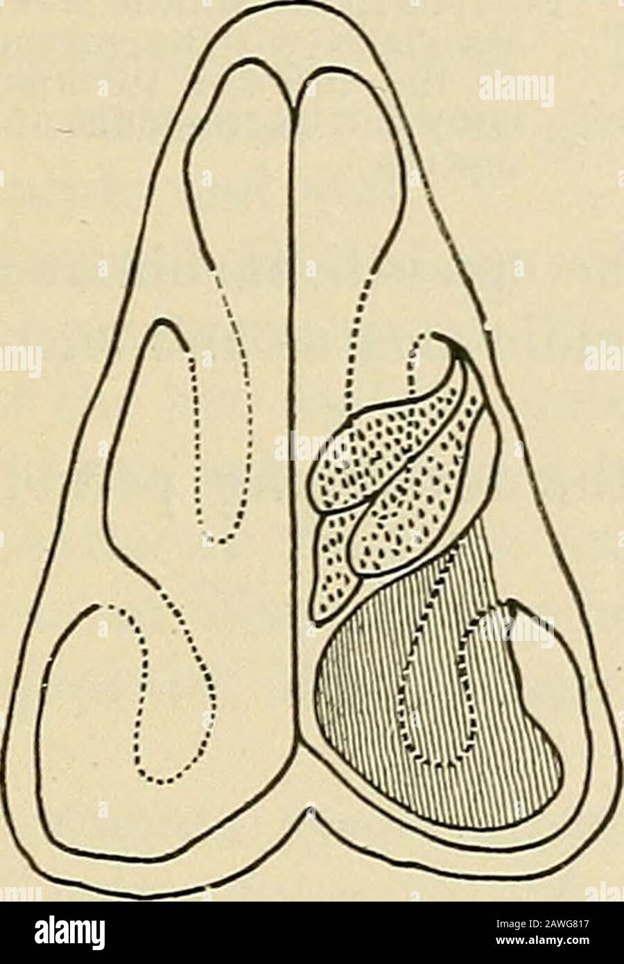 Polyp in the ear hi-res stock photography and images - Alamy