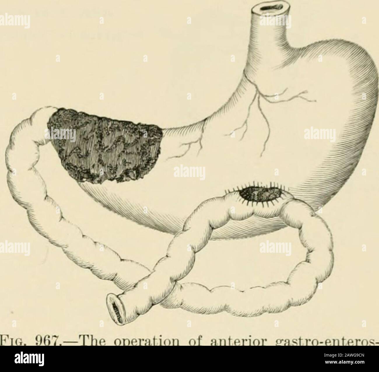 Operative surgery . )ur at the seat of union which caused a short ...