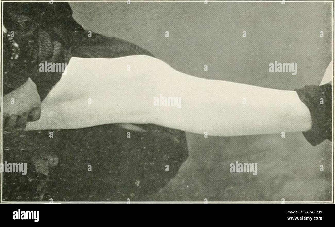 Lacerated wound hi-res stock photography and images - Alamy