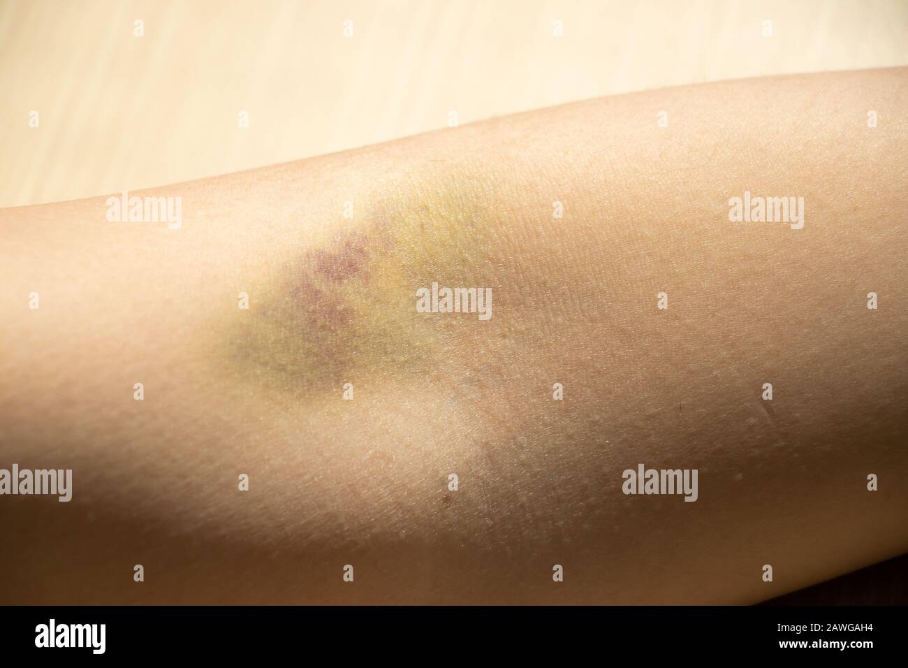 Hematoma Arm Stock Photos & Hematoma Arm Stock Images - Alamy