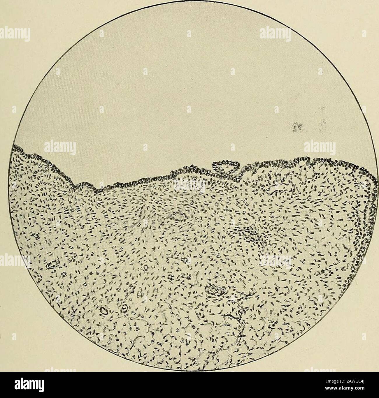 Sebaceous cysts hi-res stock photography and images - Alamy