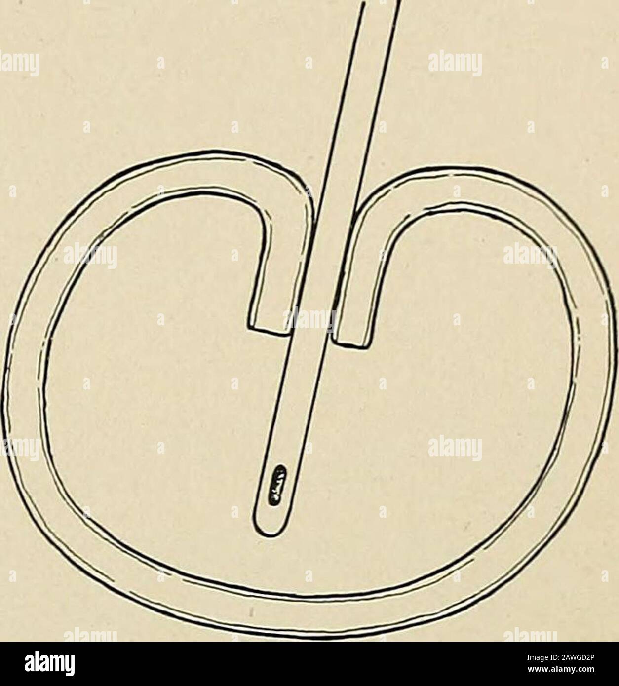 Cystostomy hi-res stock photography and images - Alamy