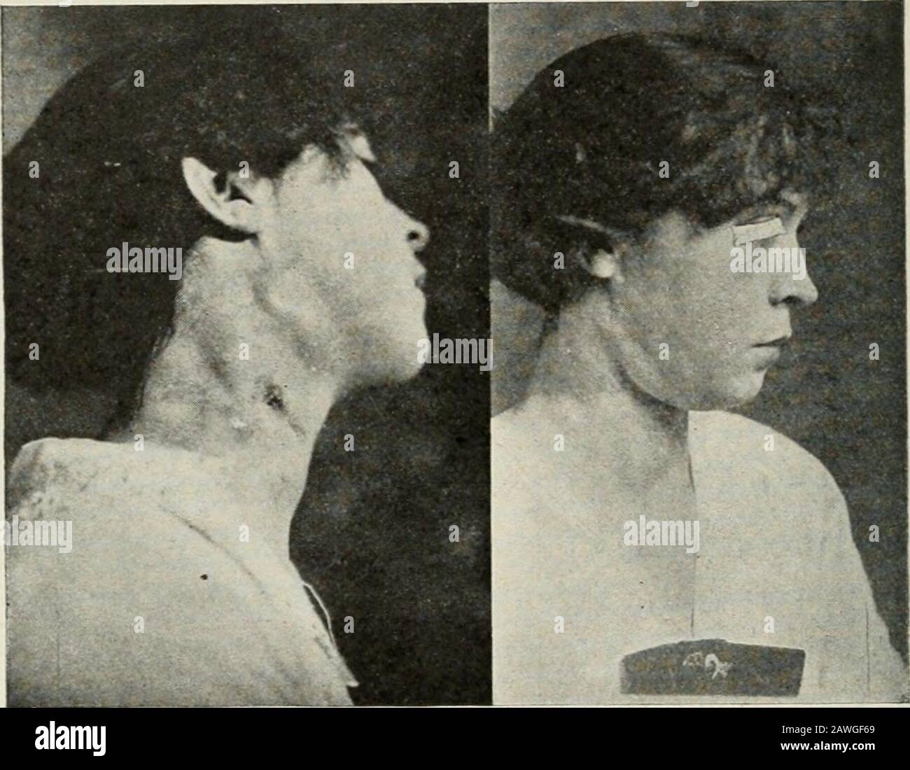 Erythema multiforme hi-res stock photography and images - Alamy