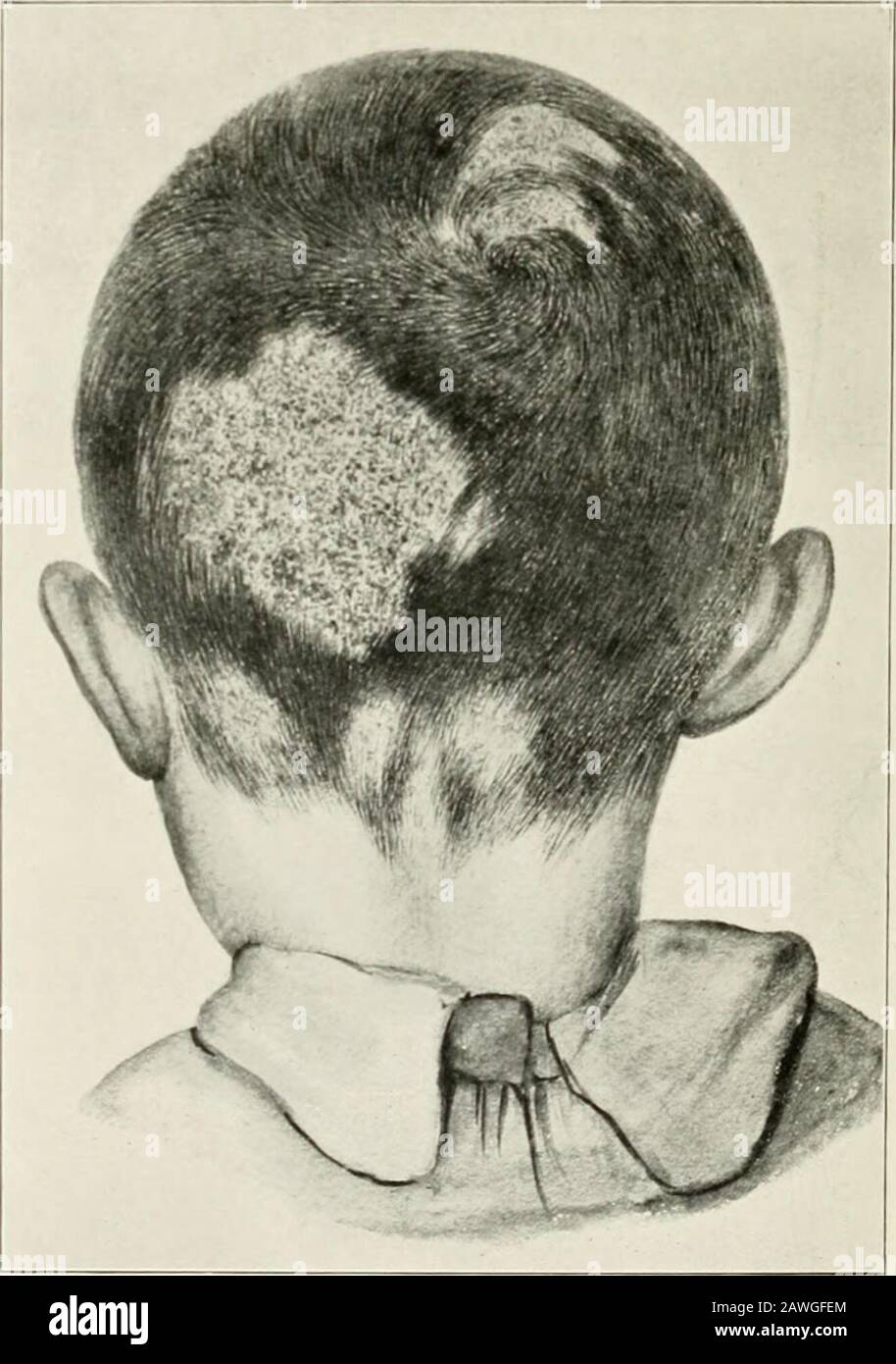 Black dot ringworm hi-res stock photography and images - Alamy