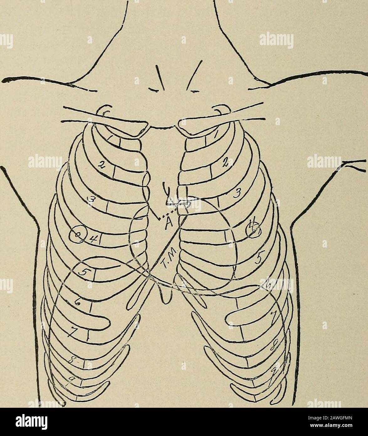 Operative surgery, for students and practitioners . t. The Outlines of ...