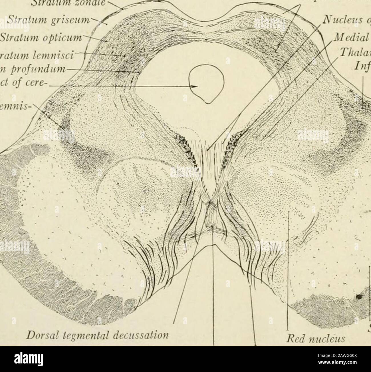 Anatomia Do Plano Longitudinal Central Calcaneal Osteotomy For