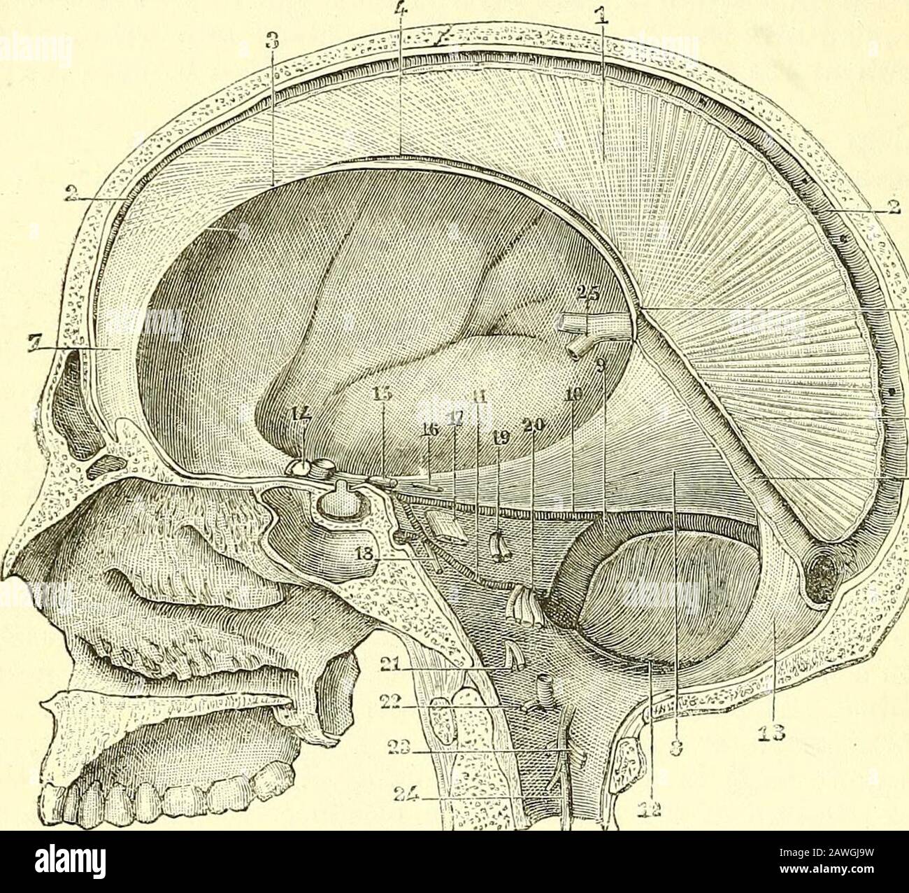Pronounced Coronal Ridge