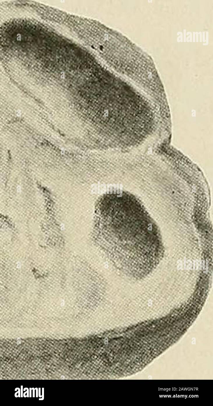 Gynecology . Fig. 122.—Cystic Degeneration of the Ovary.Macroscopic ...