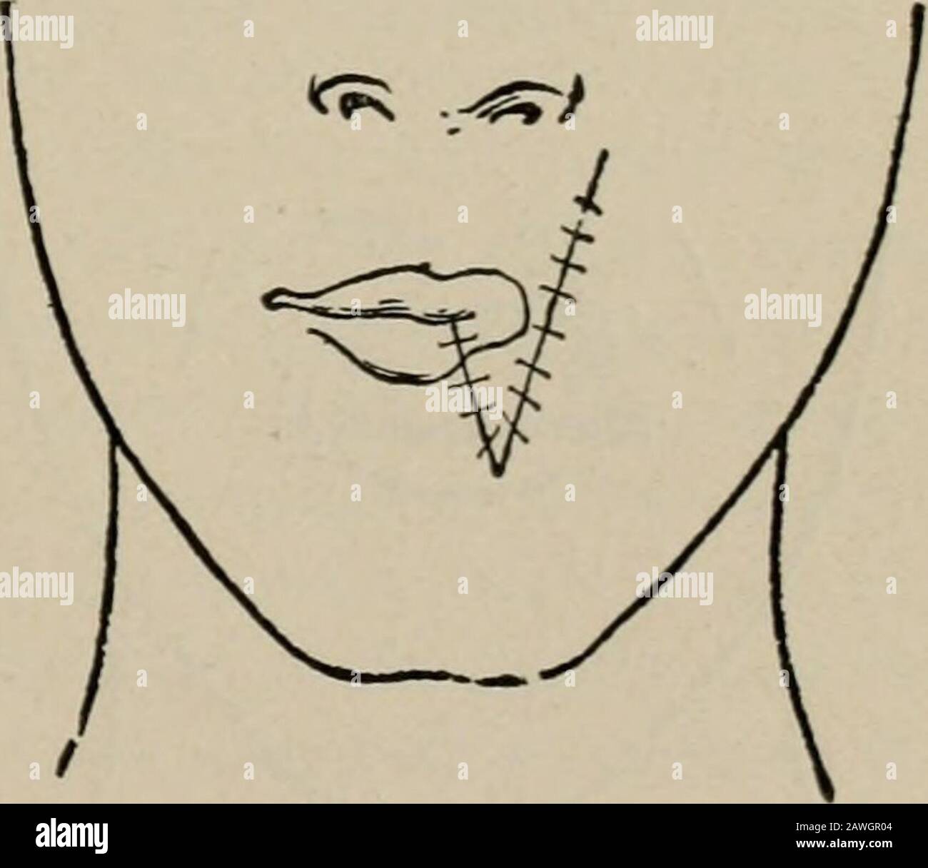 Operative surgery, for students and practitioners . Fig. 129 ...