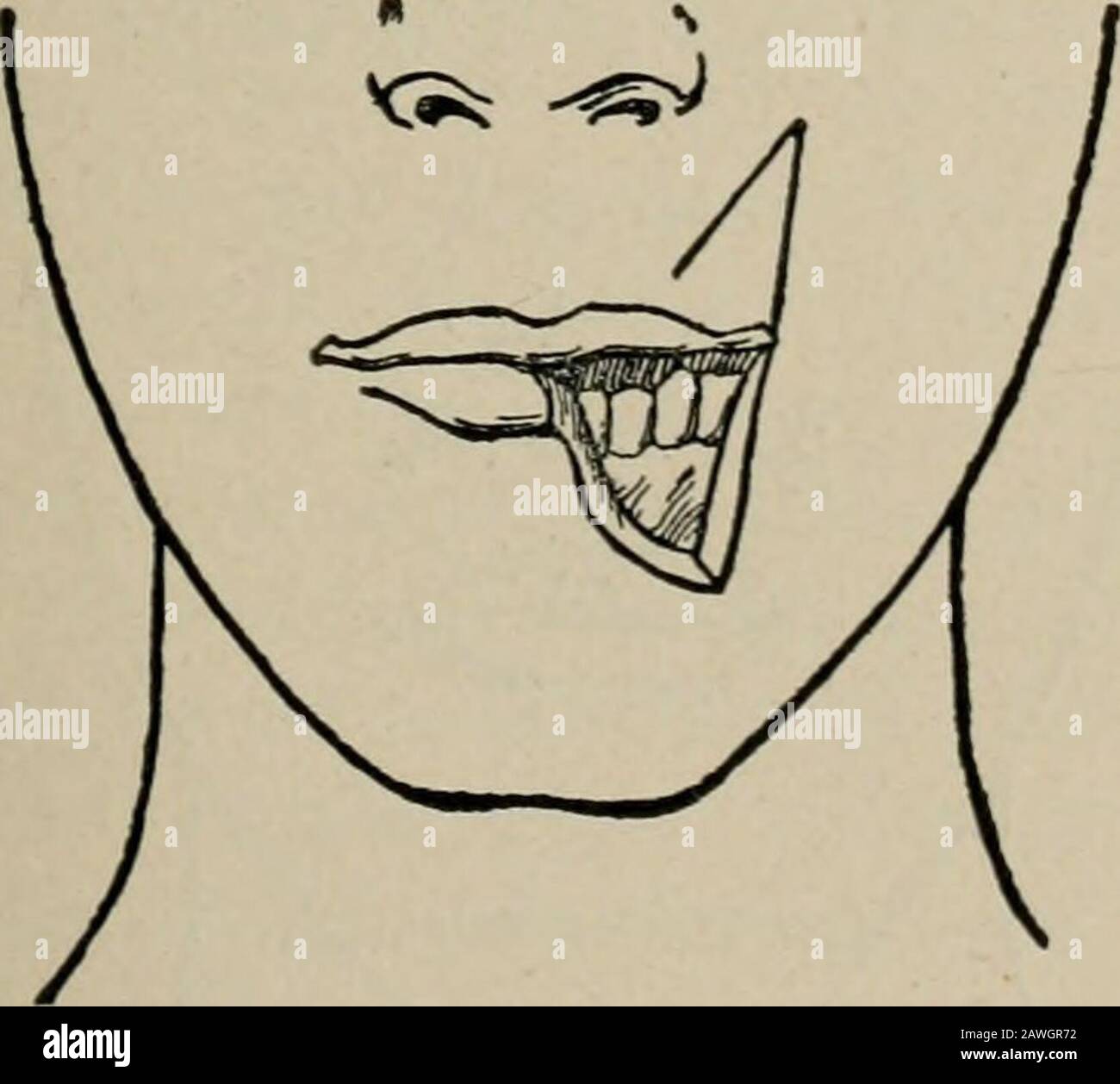 Operative surgery, for students and practitioners . Fig. 127 ...