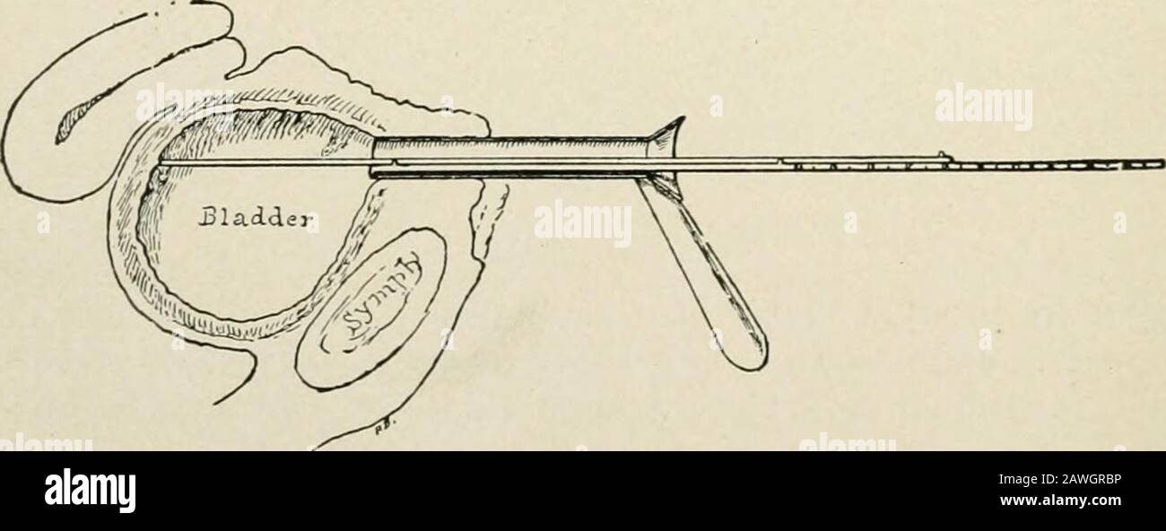 Cystoscope hi-res stock photography and images - Alamy