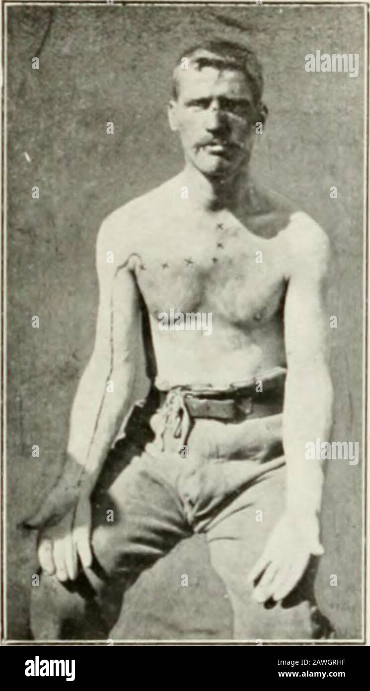 Apex of lung hi-res stock photography and images - Alamy