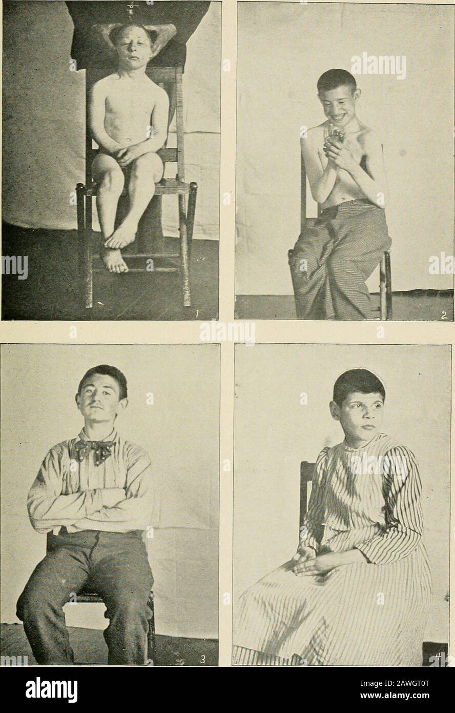 Cretinism hi-res stock photography and images - Alamy