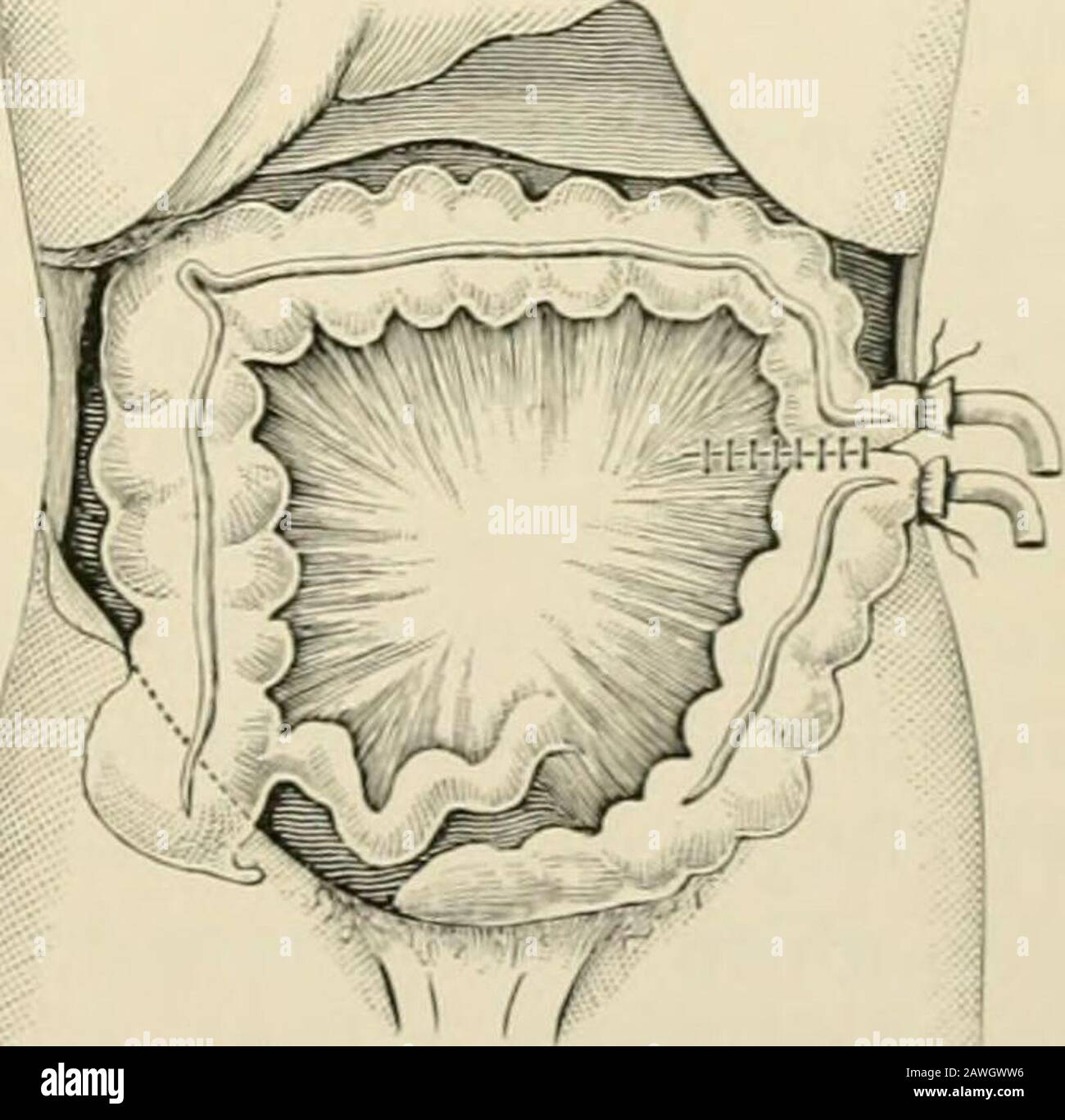 Bowel loop hi-res stock photography and images - Alamy