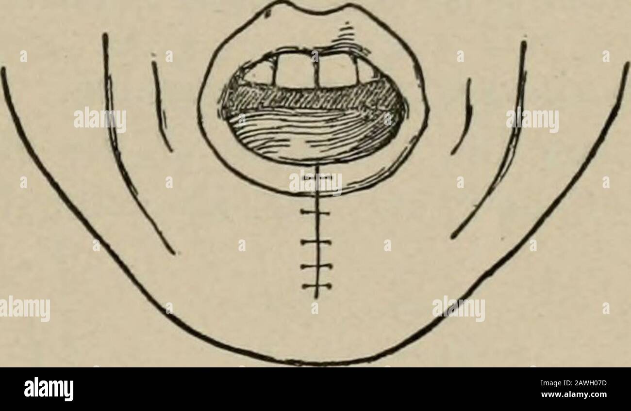 Operative surgery, for students and practitioners . Fig. 122.—Excision ...