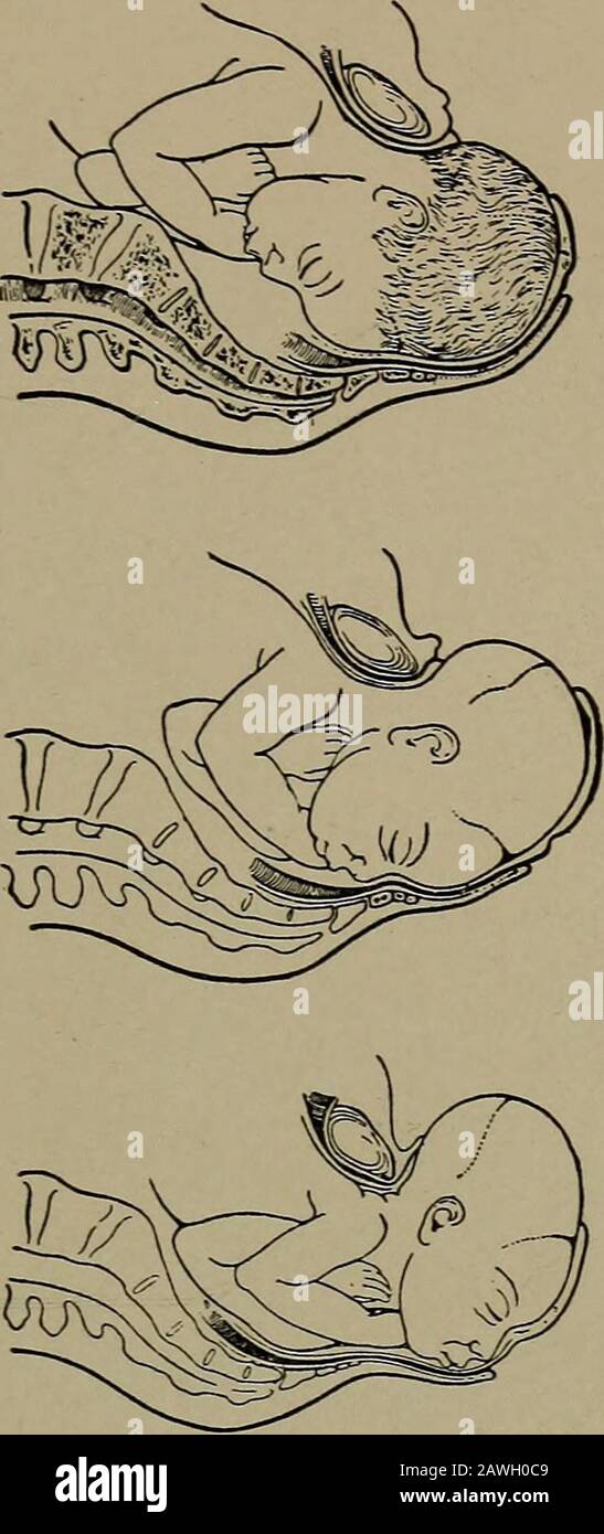 Occiput posterior hi-res stock photography and images - Alamy