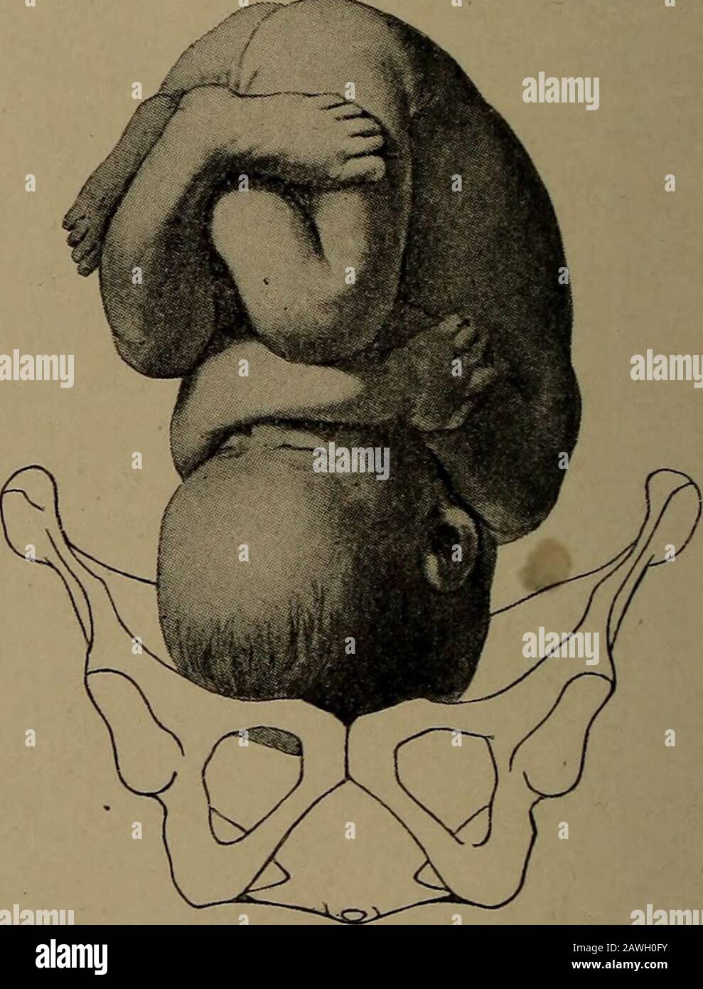 A nurse's handbook of obstetrics, for use in training-schools . Fig. 41 ...