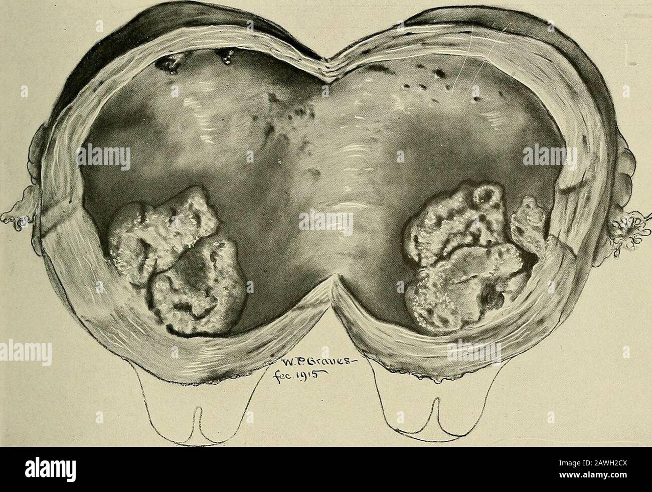Gynecology . CcvrCfcv Ni.-R&rcvuc?.. Fig. 103.—Hydrometra.In this case ...