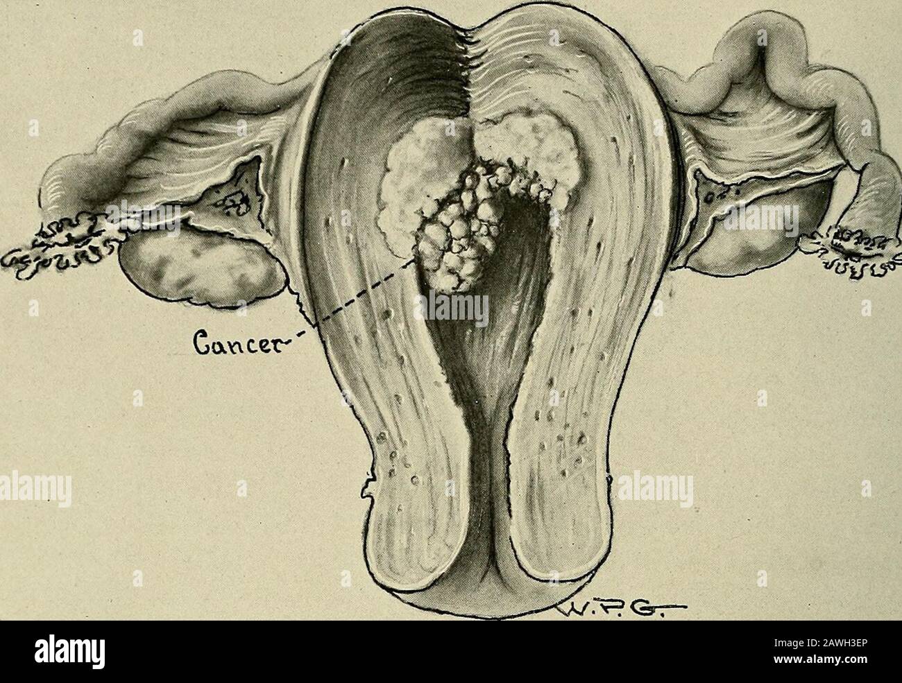 Gynecology . processes. The anatomic type of cancer of the body is ...