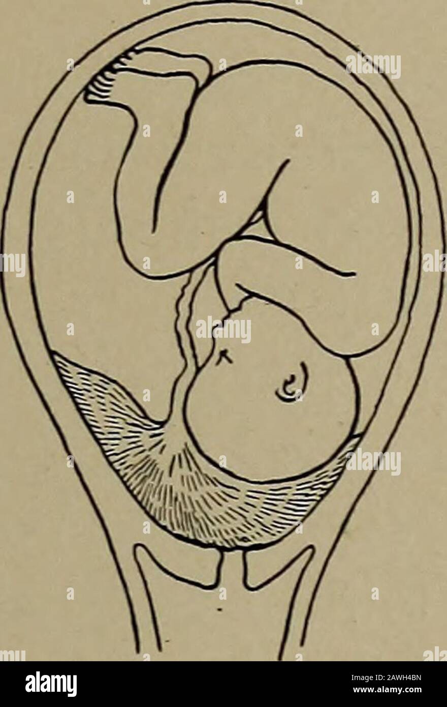 A nurse's handbook of obstetrics, for use in training-schools . Fig. 35 ...