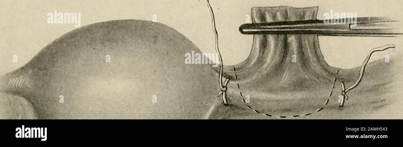 Ovary cysts hi-res stock photography and images - Alamy