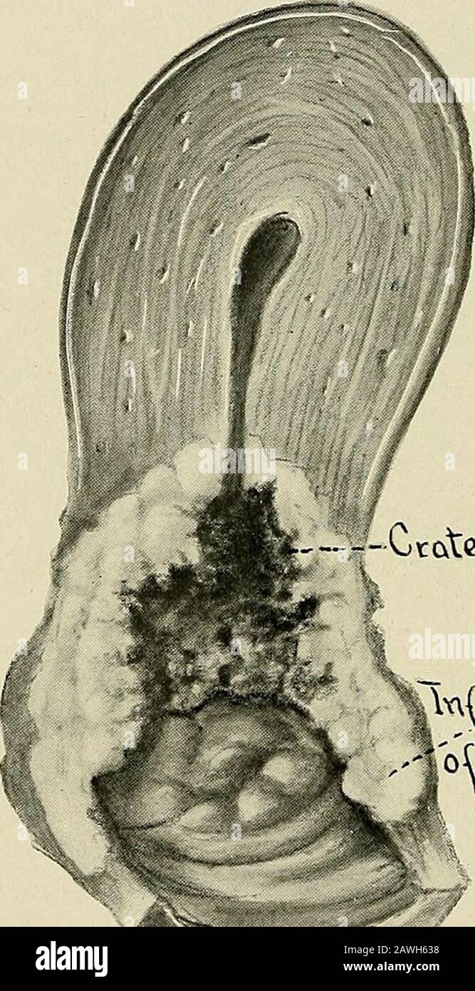 Gynecology . mportance of curetage for diagnosis, as this growth could ...