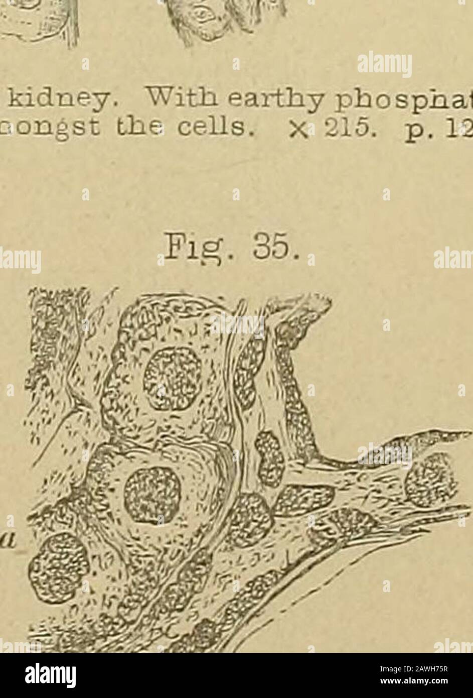 Kidney diseases, urinary deposits, and calculous disorders : their ...