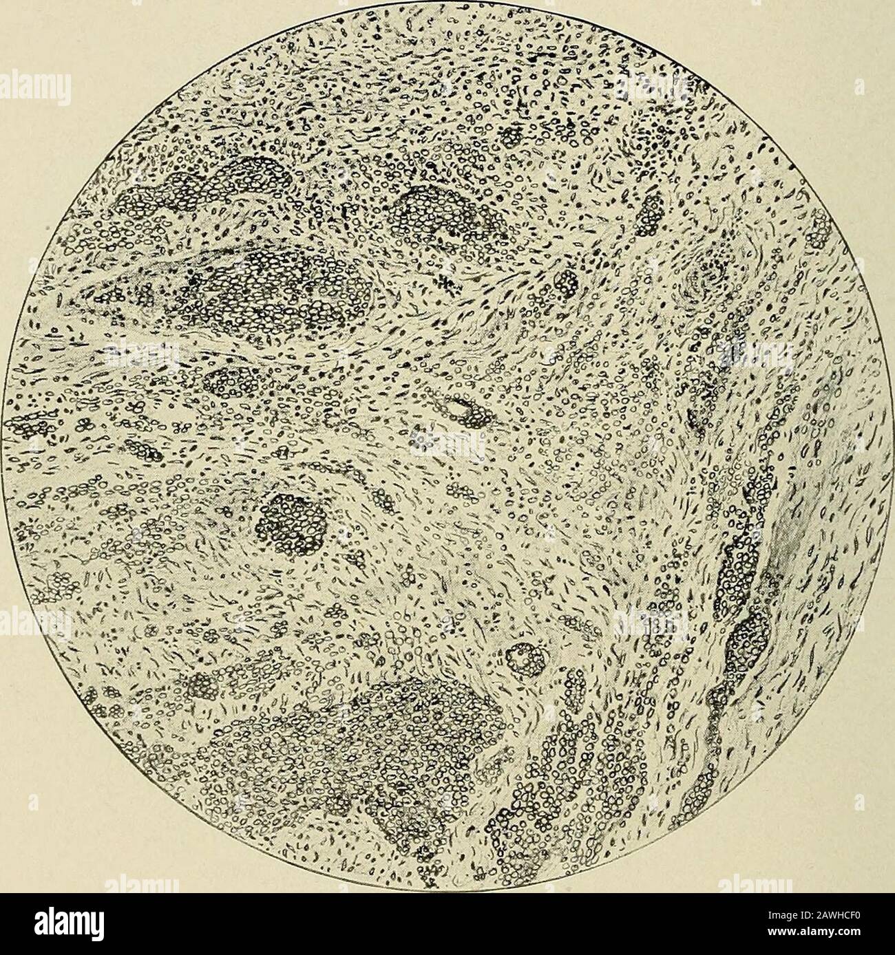Gynecology . use. Necrosis of fibroids occurs when they become deprived ...