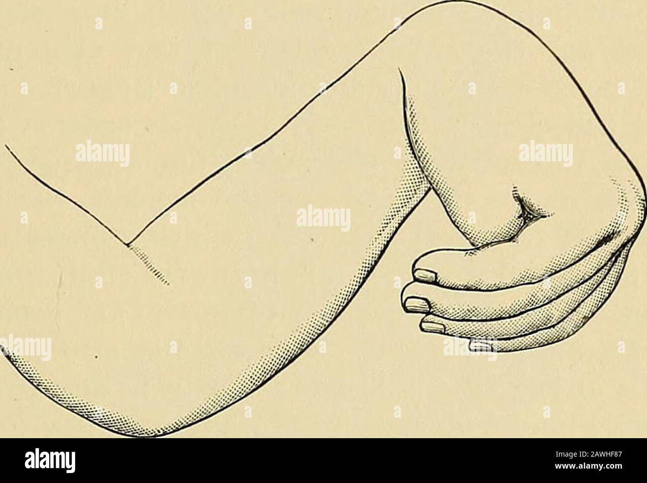 Opisthotonos hi-res stock photography and images - Alamy