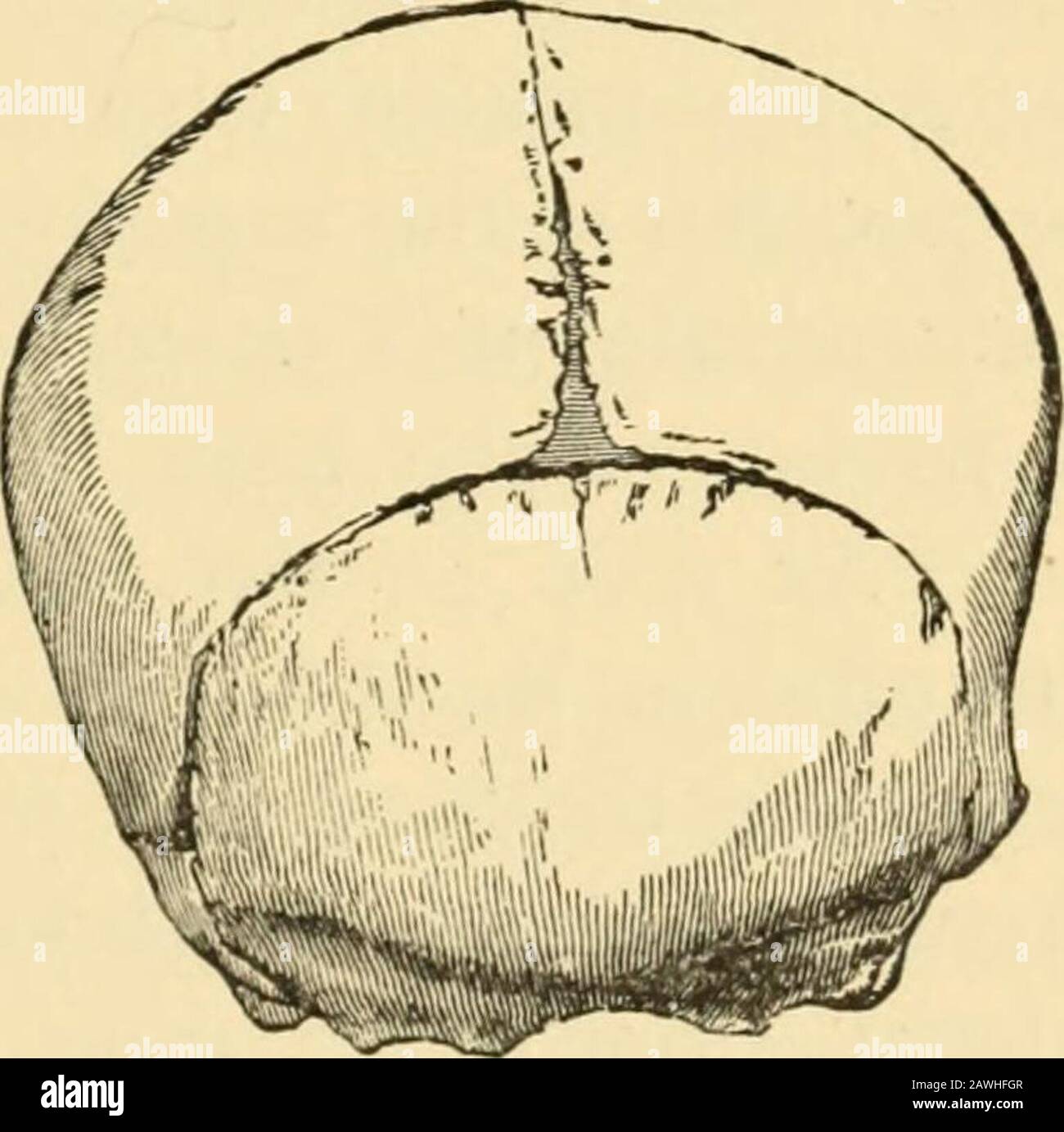 A system of obstetrics . Fig. 255.. Anterior and Posterior Fontanels ...
