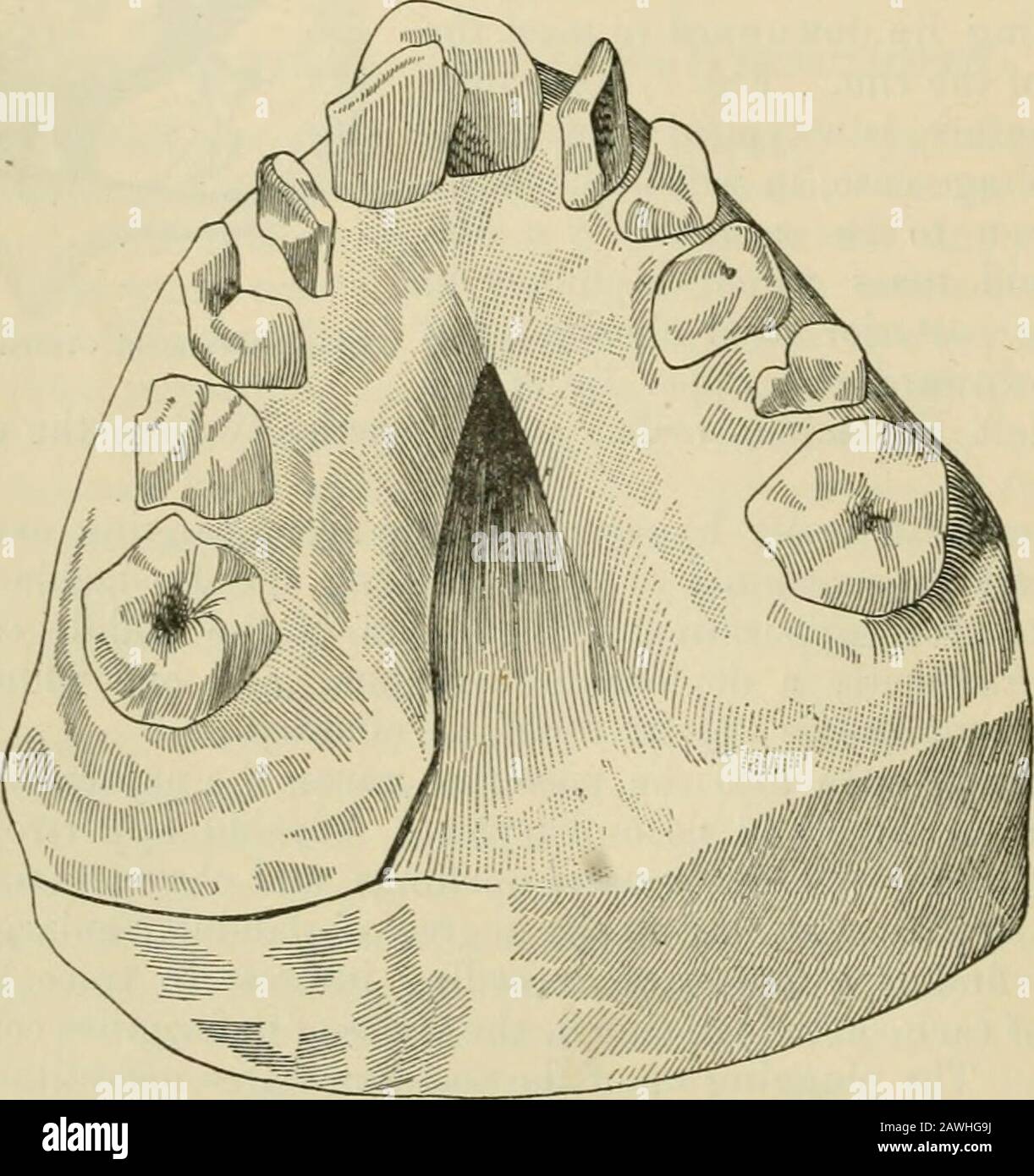 High arched palate hi-res stock photography and images - Alamy