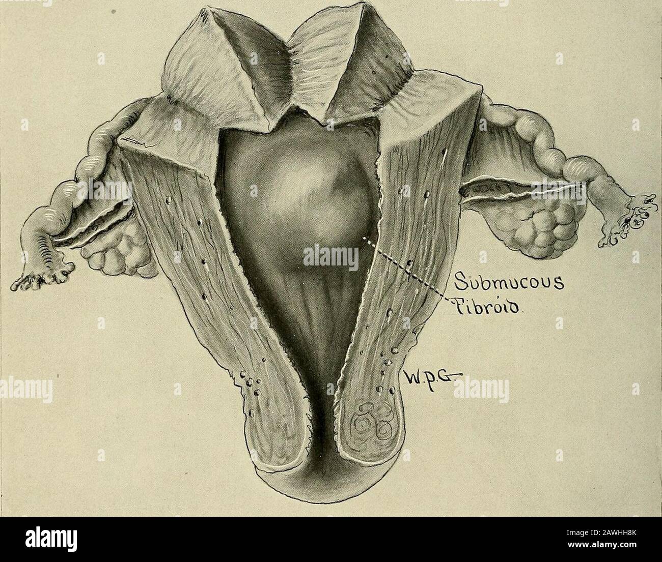 Gynecology . ing or parasitic myoma. The omentum usually attachesitself ...