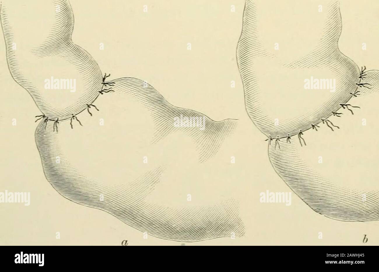 Bowel resection hi-res stock photography and images - Alamy