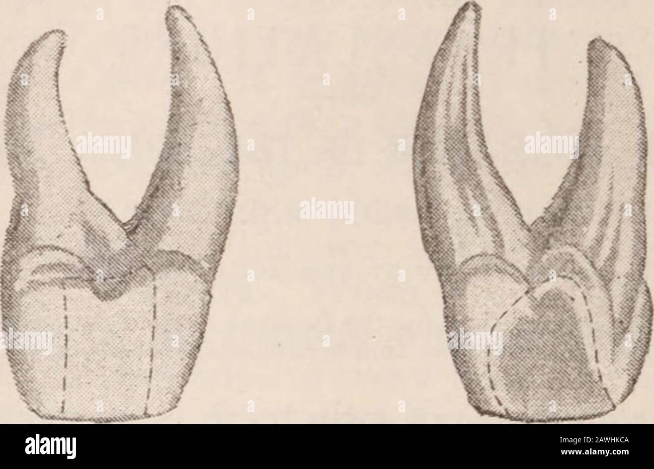 Supernumerary teeth hi-res stock photography and images - Alamy