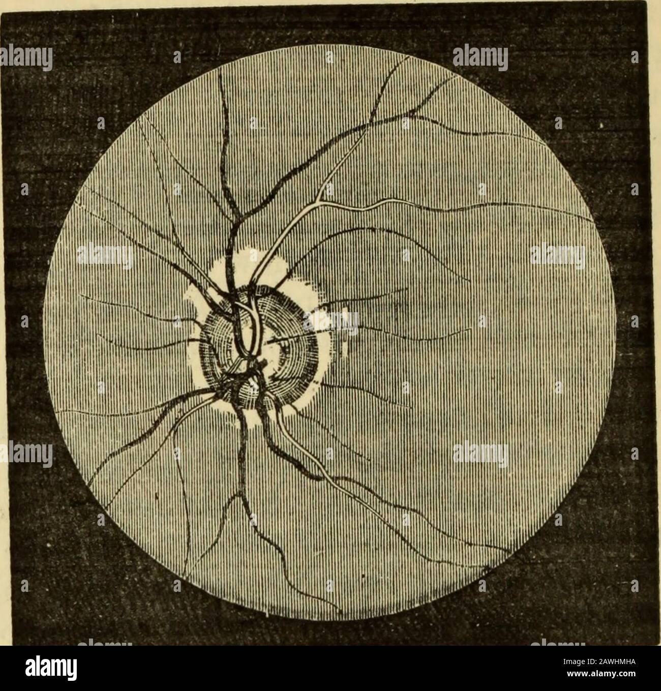 Disc cupping hi-res stock photography and images - Alamy