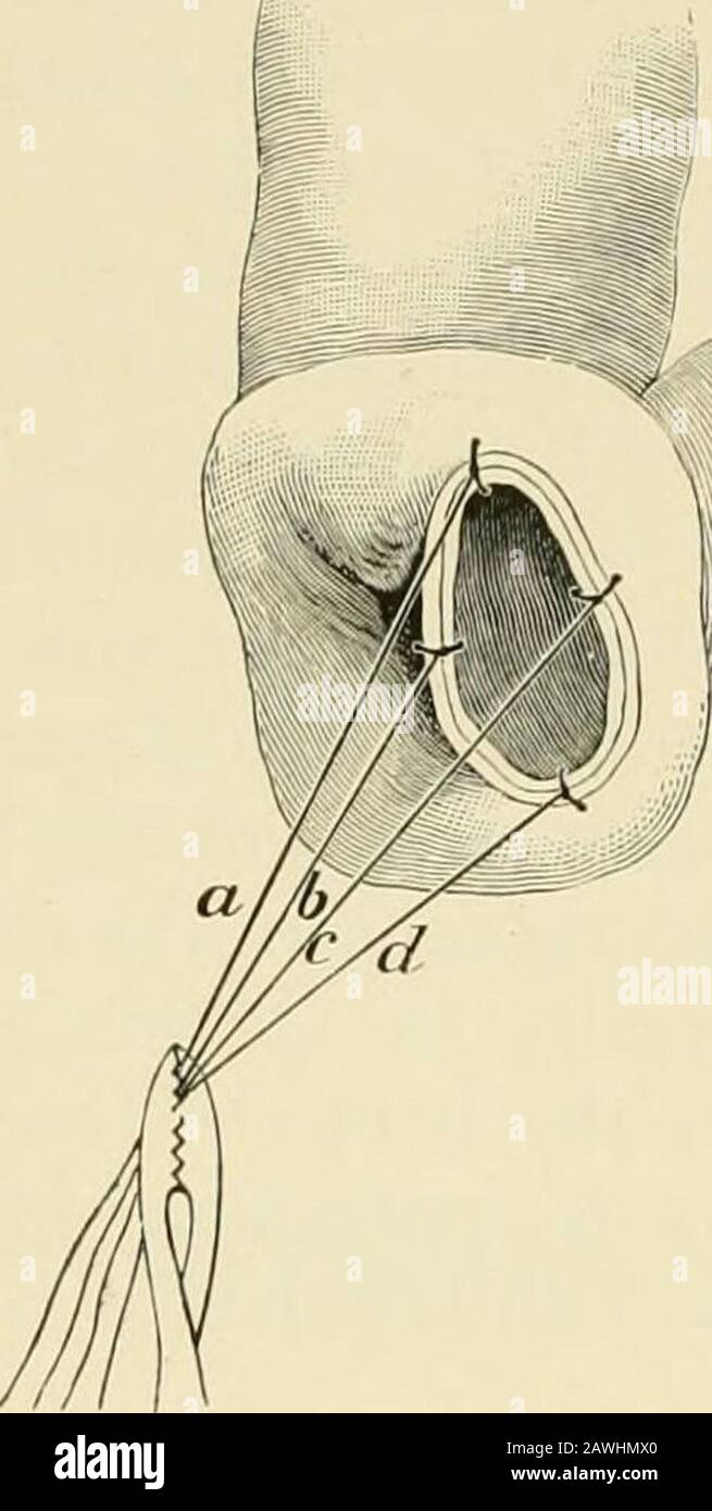 Operative surgery . Fi(i. So7. V(. 85S. Fig. 857.—Lateral implantation ...