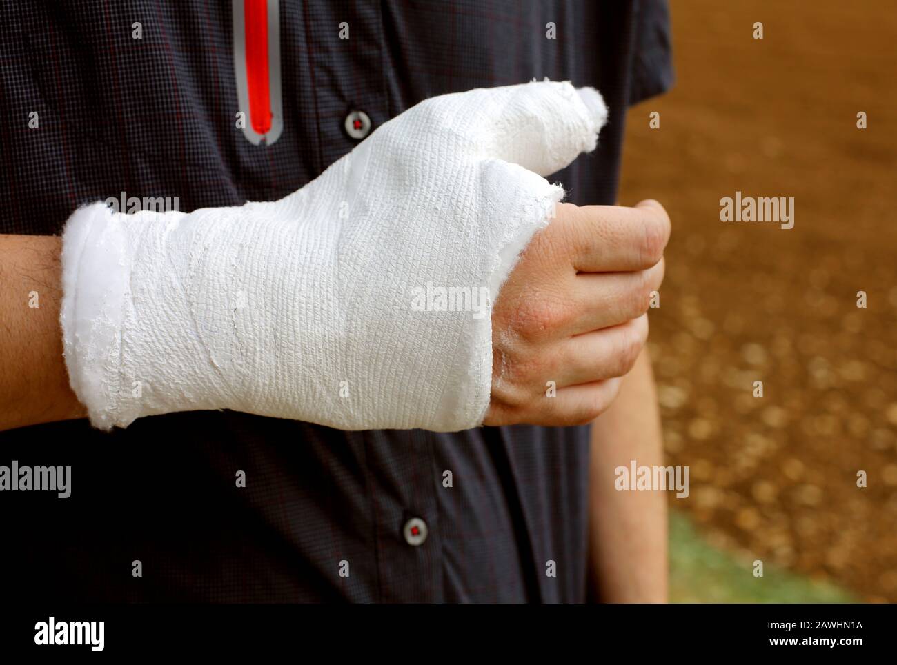Plaster after wrist fracture hi-res stock photography and images - Alamy