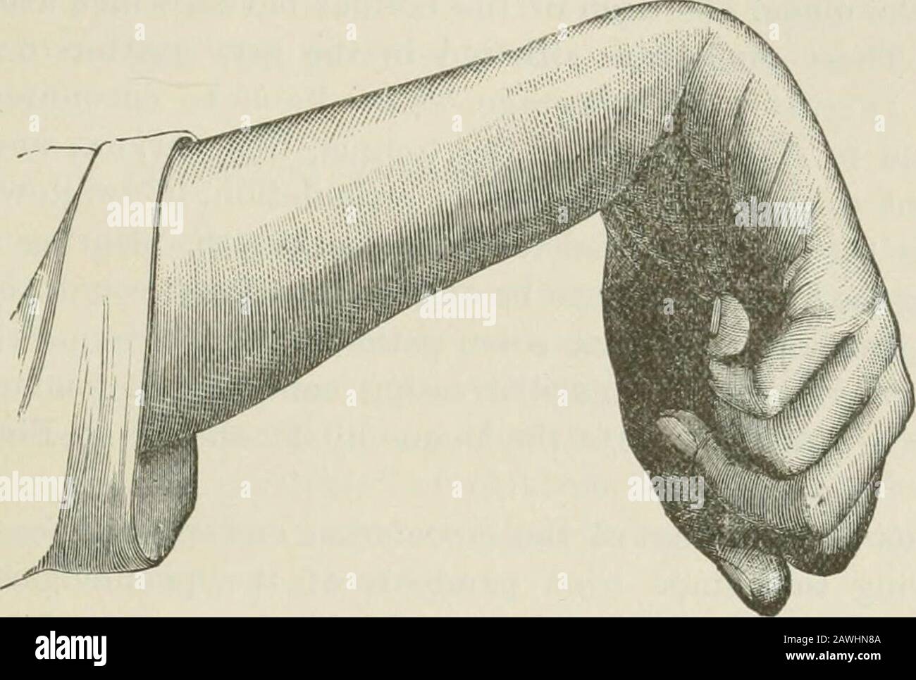 Hand deformities hi-res stock photography and images - Alamy