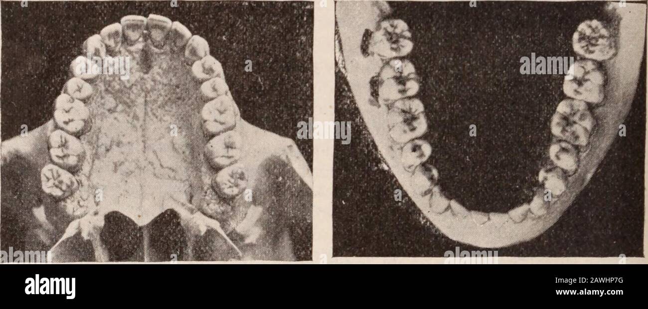 Dental cosmos . Side view from m.ture, showing normal occlusion. Fig. 8 ...