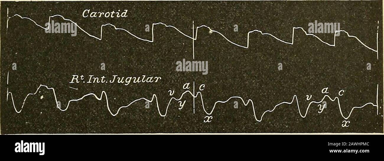 Carotid Pulse Tracing