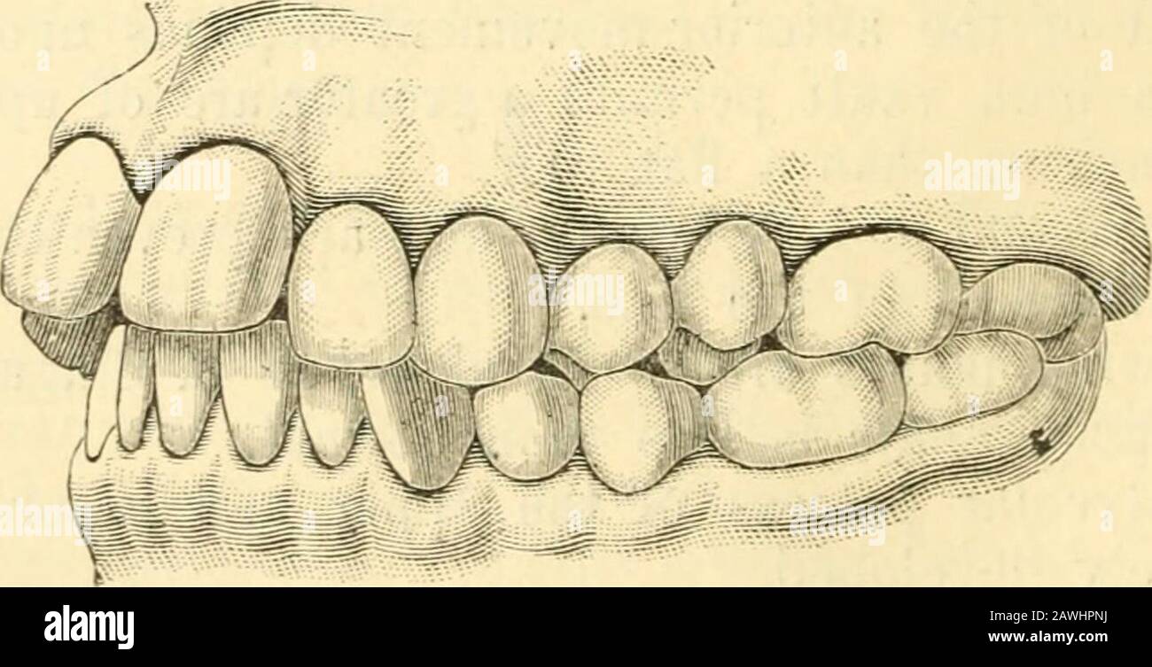 Alveolar process of maxilla hi-res stock photography and images - Alamy