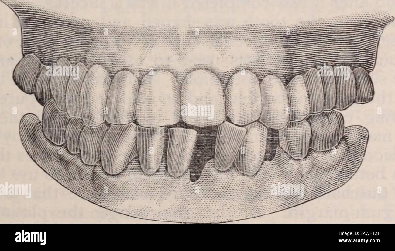 Dental cosmos . 26 is a model of the lower jaw, showing the ...