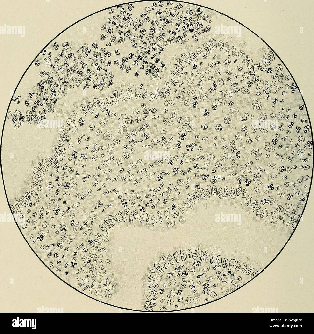 Endometritis hi-res stock photography and images - Alamy