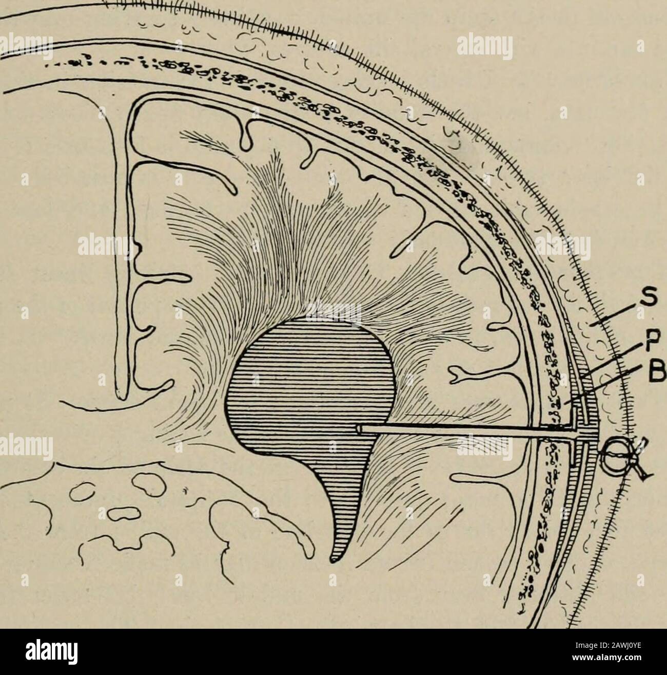 Operative surgery, for students and practitioners . )irating needle ...