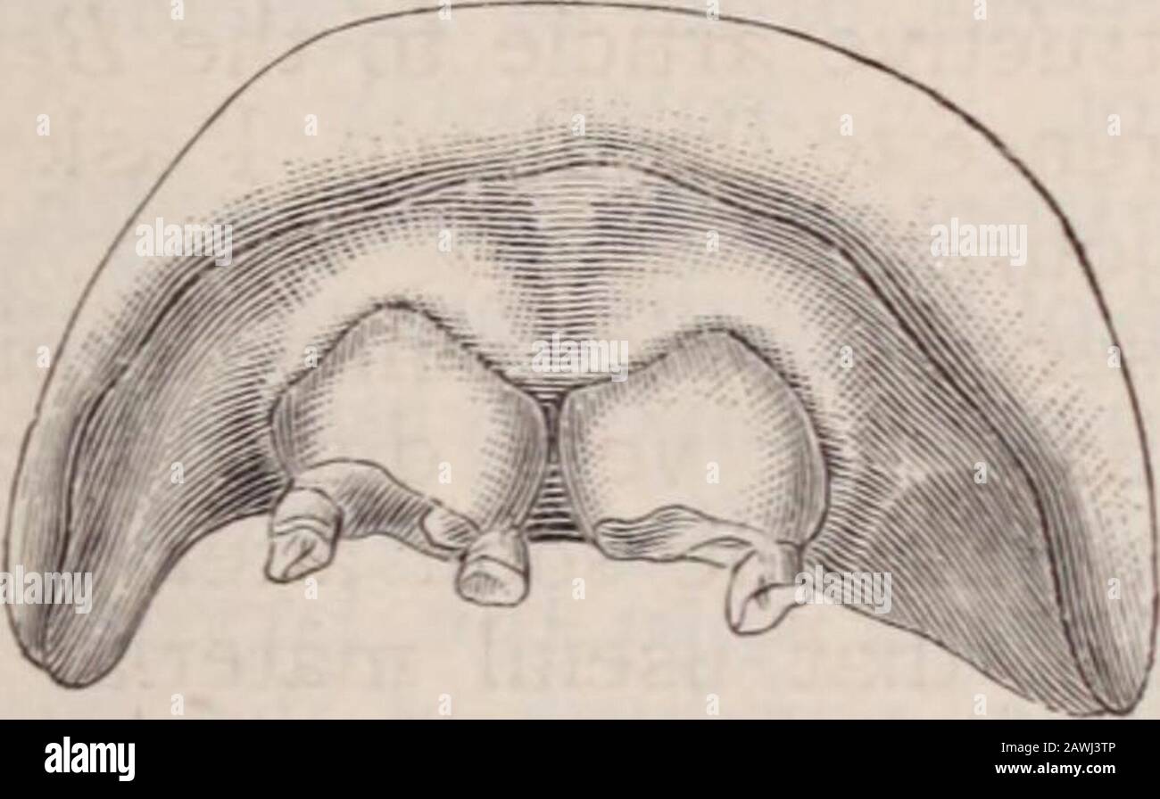 Tartar formation hi-res stock photography and images - Alamy