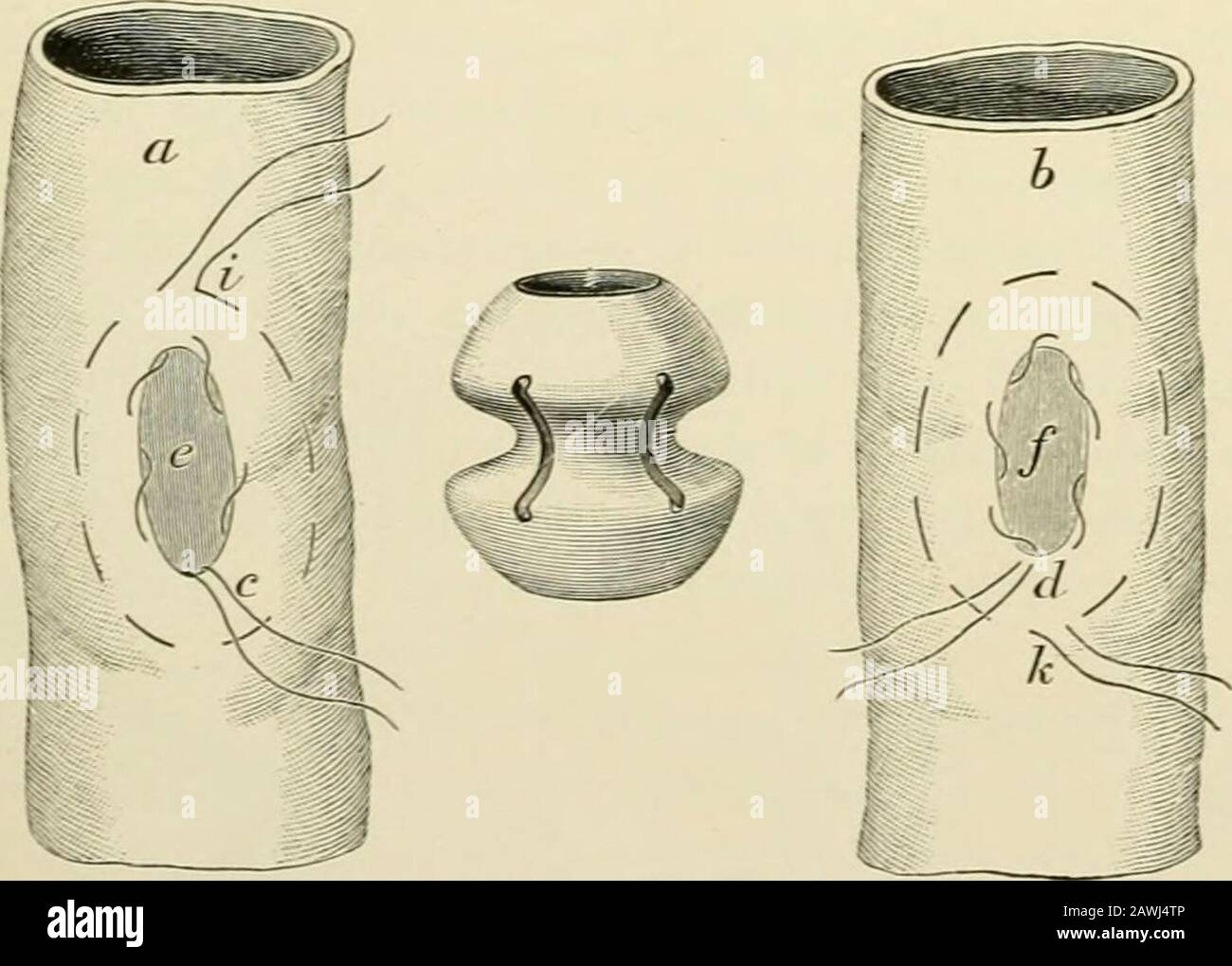 Operative surgery . ig. 825.—The bone bobbin of Hayes, a, b. Grooves in ...