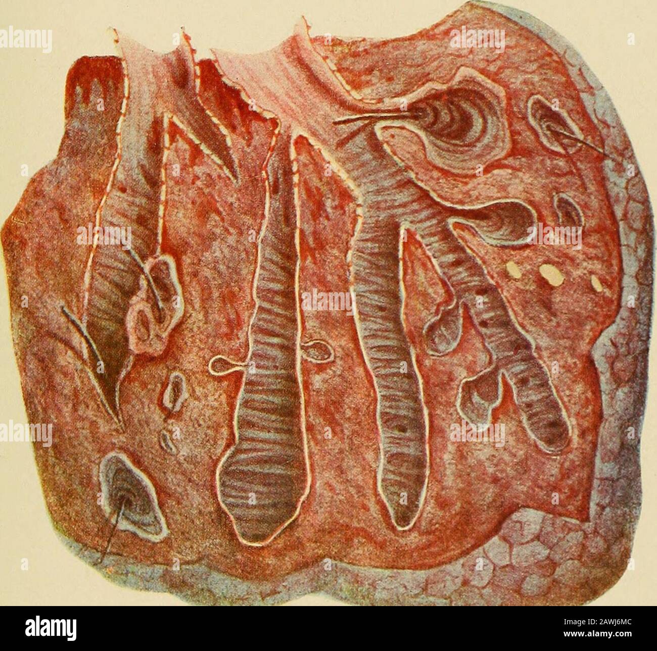 Sputum hospital hi-res stock photography and images - Alamy